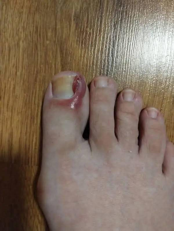 Cómo Curar un Uñero en Casa: Remedios Caseros y Consejos Prácticos ...